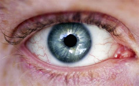 Gene Therapy For Blindness Approved By Fda In Groundbreaking Moment For