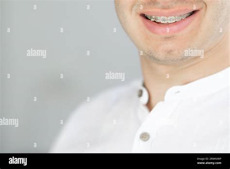 Close Up Of The Smile Of A Handsome Young Man With Braces Smiling With