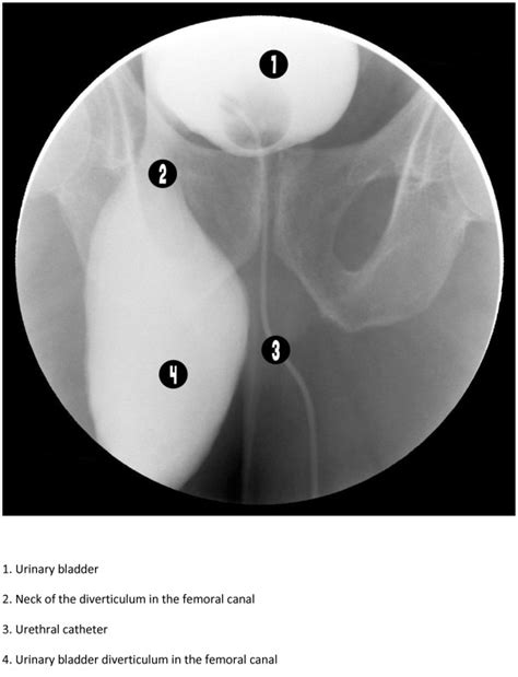 Retrograde Urethrocystogram Showing The Urinary Bladder Diverticulum