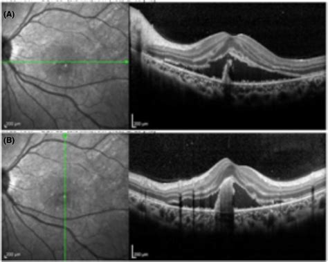 Optical Tomographic Interferometer With The Horizontal Line A And