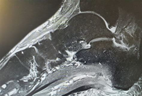 Diagnóstico de la fascitis plantar CIRUGIA PIE Y TOBILLO DR BALLESTER
