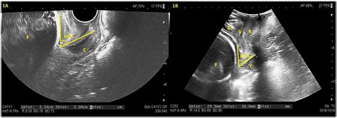 Comparison Of Transvaginal And Transperineal Ultrasonographic