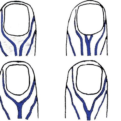 A Level Of Amputation Hirase Classification B Level Of Download Scientific Diagram