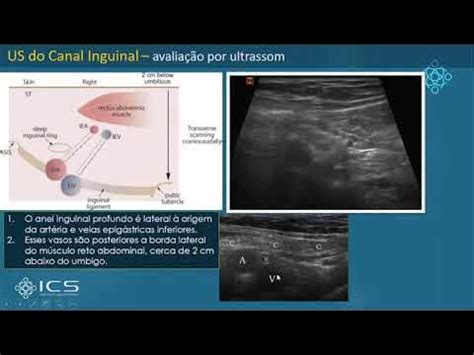 Ultrassom Do Canal Inguinal Dr Carlos Stefano Youtube