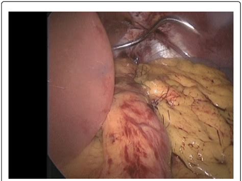 Omental Patch Fixation Covering The Whole Staple Line Download