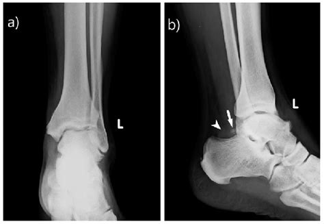 Pre Operative Plain Radiographs Of The Ankle A Anteroposterior