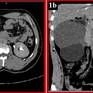 A 1b Axial And Coronal Section Of Contrast CT Showing Large Right