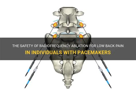 The Safety Of Radiofrequency Ablation For Low Back Pain In Individuals