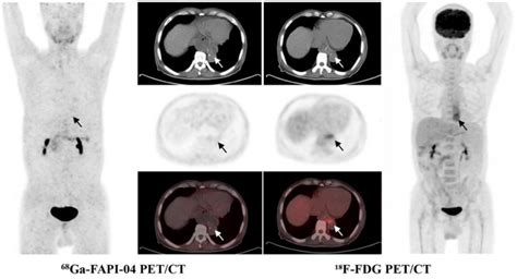 Fapi Fdg Recurrence A 67 Year Old Male Patient Id 28 With
