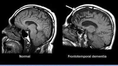 Brain Scan Frontal Lobe Dementia Imaging Of A Living Brain Can Help