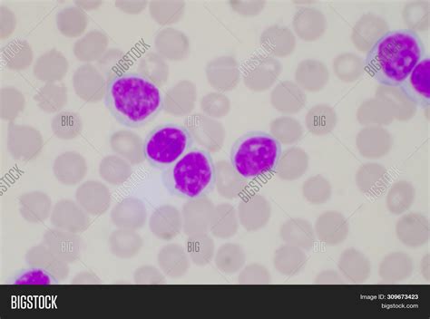 Blast Cells Immature Image And Photo Free Trial Bigstock