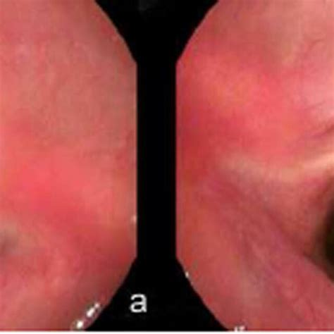 A Laryngoscopy Revealed Laryngeal Mucosa Hyperaemia And Milky