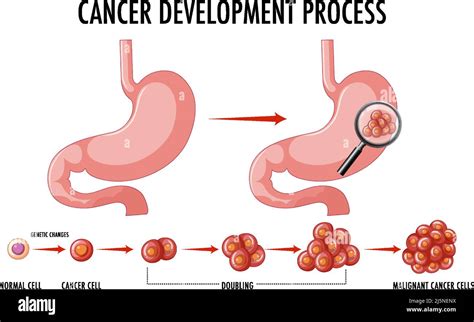 Diagram Showing Cancer Development Process Illustration Stock Vector