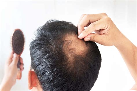 Hair Loss Near Your Hair Parting Crown Or Temples Hana Story