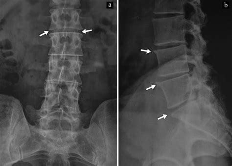 Lateral X Ray Lumbar Spine Lumbar Spine Imaging Gcdj