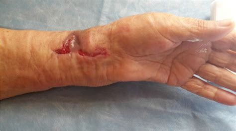 An Aggressive Course Of Pyoderma Gangrenosum Mimicking Bacterial