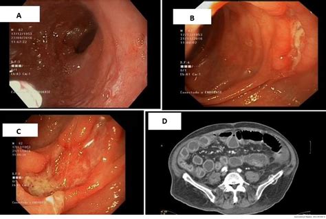 Ulcerative Jejunitis Serious And Uncommon Manifestation In The