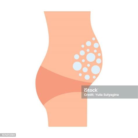 팽만감 헛배 부름 배에 거품이있는 인간의 튀어 나온 배 과민성 대장 증후군 Ibs 장과 위장의 증상 벡터 팽만증에 대한 스톡