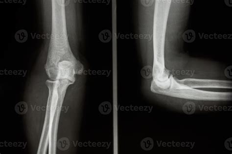 Elbow X Ray Positioning At Judy Roybal Blog