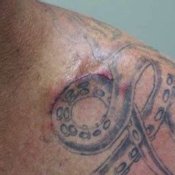 Clavicle Fracture Surgery Dr David Duckworth