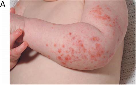 Mенингококкт халдвараар гурван тохиолдол бүртгэгдэж нэг хүүхэд нас баржээ Ontsgoi Mn