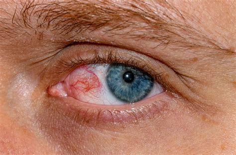 What Causes Broken Blood Vessels In Eyes