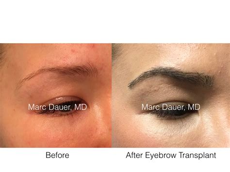 Eyebrow Transplant Photos Gallelry Marc Dauer Md