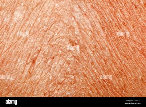 Lichen Sclerosis Close Up Of Lichen Sclerosis On The Body Of A 57 Year