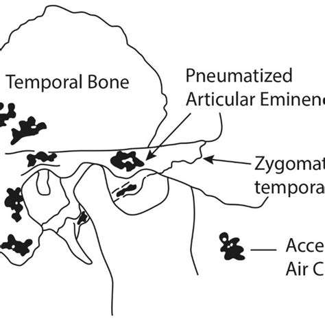 Pdf Pneumatization Of The Zygomatic Process Of Temporal Bone On