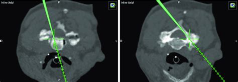 Unilateral Laminotomy For Over The Top Bilateral Decompression