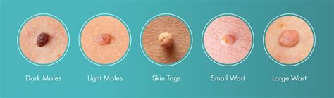 Difference Between Genital Warts And Skin Tags Genital Warts Removal