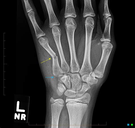 Metacarpal Fracture Return To Sport At Sandra Raines Blog