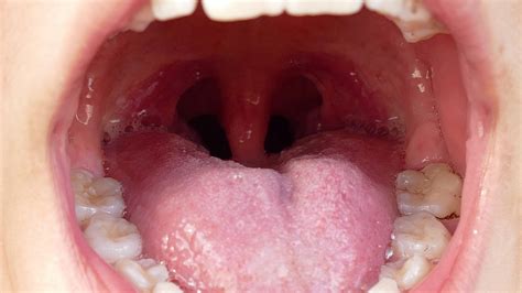 Tonsil Stones Infection
