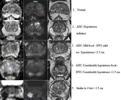 Pi Rads In Peripheral Zone Pz 13 14 Download Scientific Diagram