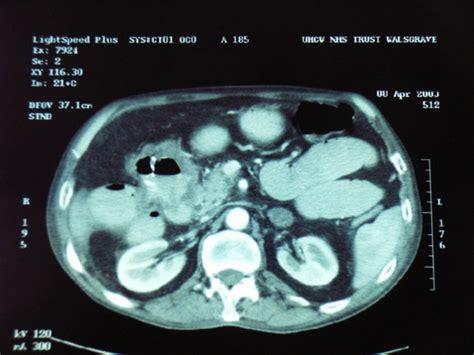 Abdominal Ct Showing A Locally Advanced Tumour In Proximal Transverse