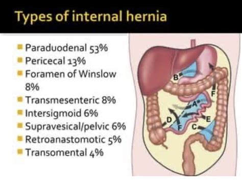 Internal Hernia Types And Treatment Dr Avinashtank Is A Super