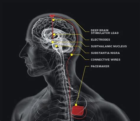 Another Treatment For Parkinson S Dbs Deep Brain