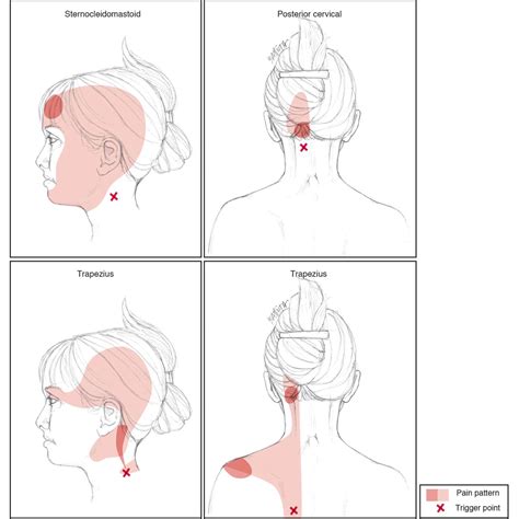 Scalenes Trigger Points