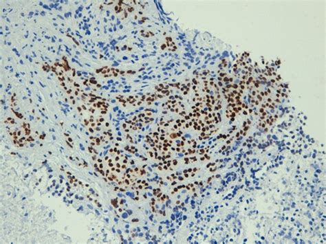 Squamous Cell Carcinoma In The Stomach