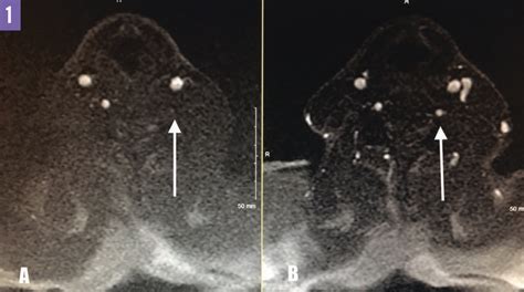 Subclavian Steal Syndrome Consultant360