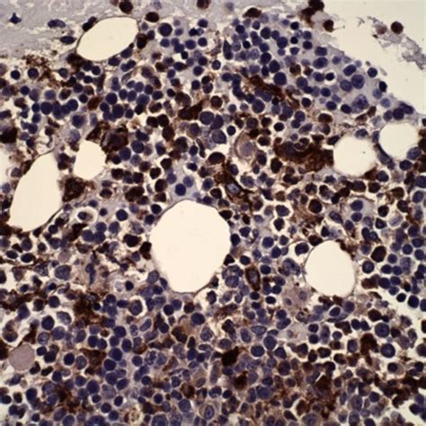 Bone Marrow Biopsy The Ihc Stain Was Also Positive For Kp1 Cd68