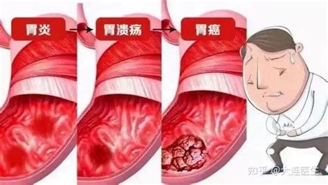 糜烂性胃炎是胃烂了吗 知乎