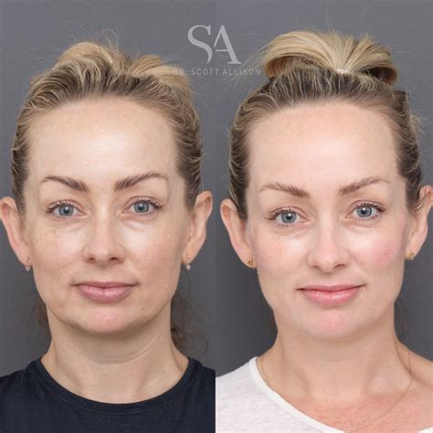 Cheek Filler Brisbane Boost Volume And Hydration