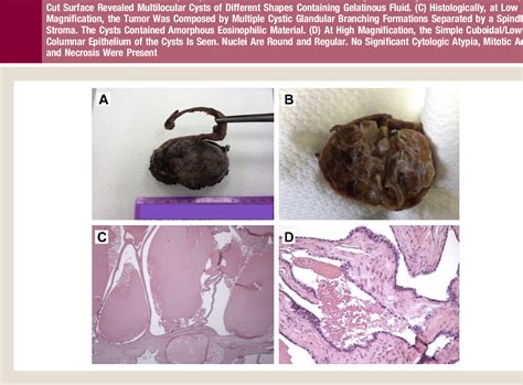 Seminal Vesicle Cystadenoma Semantic Scholar