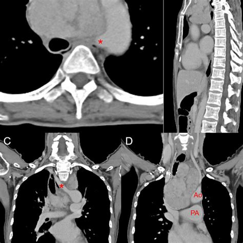 Chest Contrast Enhanced Computed Tomography Revealing A Huge Mass