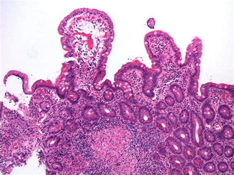 A Pouch Mucosal Biopsy From A Patient Whose Colectomy Specimen Showed