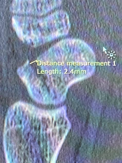 Scaphoid Fracture Does This Need Surgery R Brokenbones