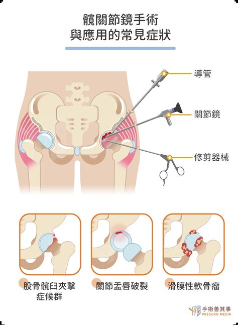 傷口小、術後恢復快 微創關節鏡手術正夯