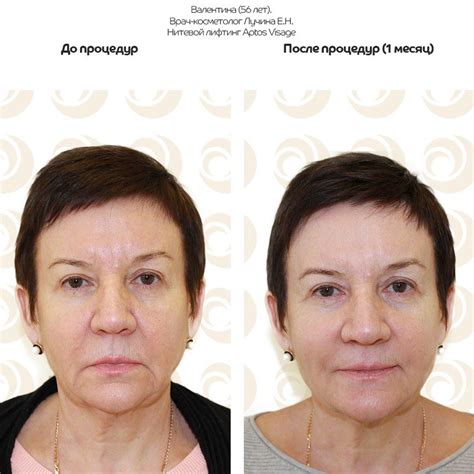 Подтяжка лица нитевой лифтинг филлеры ботокс фото до и после