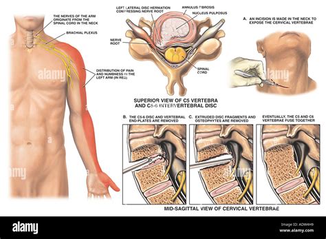 Cervical Disc Herniation Paracentral Left Arm Nerve Pain